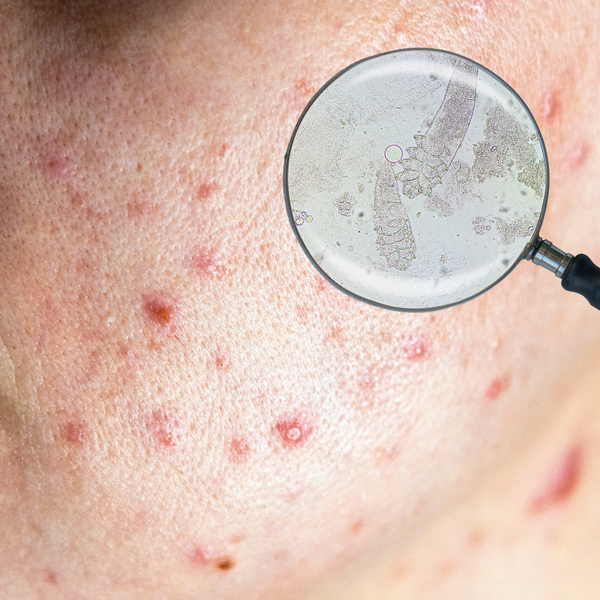 The Link Between Demodex Mites and Acne: Causes, Symptoms, and ...